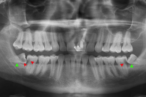 Underwood Wisdom Teeth Removal Wisdom Tooth Management